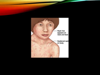 Approach to a child with fever and rash | PPTX