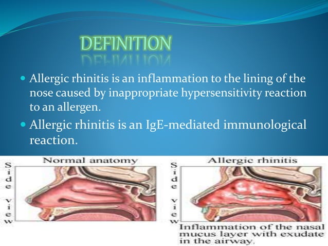 Allergic rhinitis | PPTX | Lung and Respiratory Health | Diseases and ...