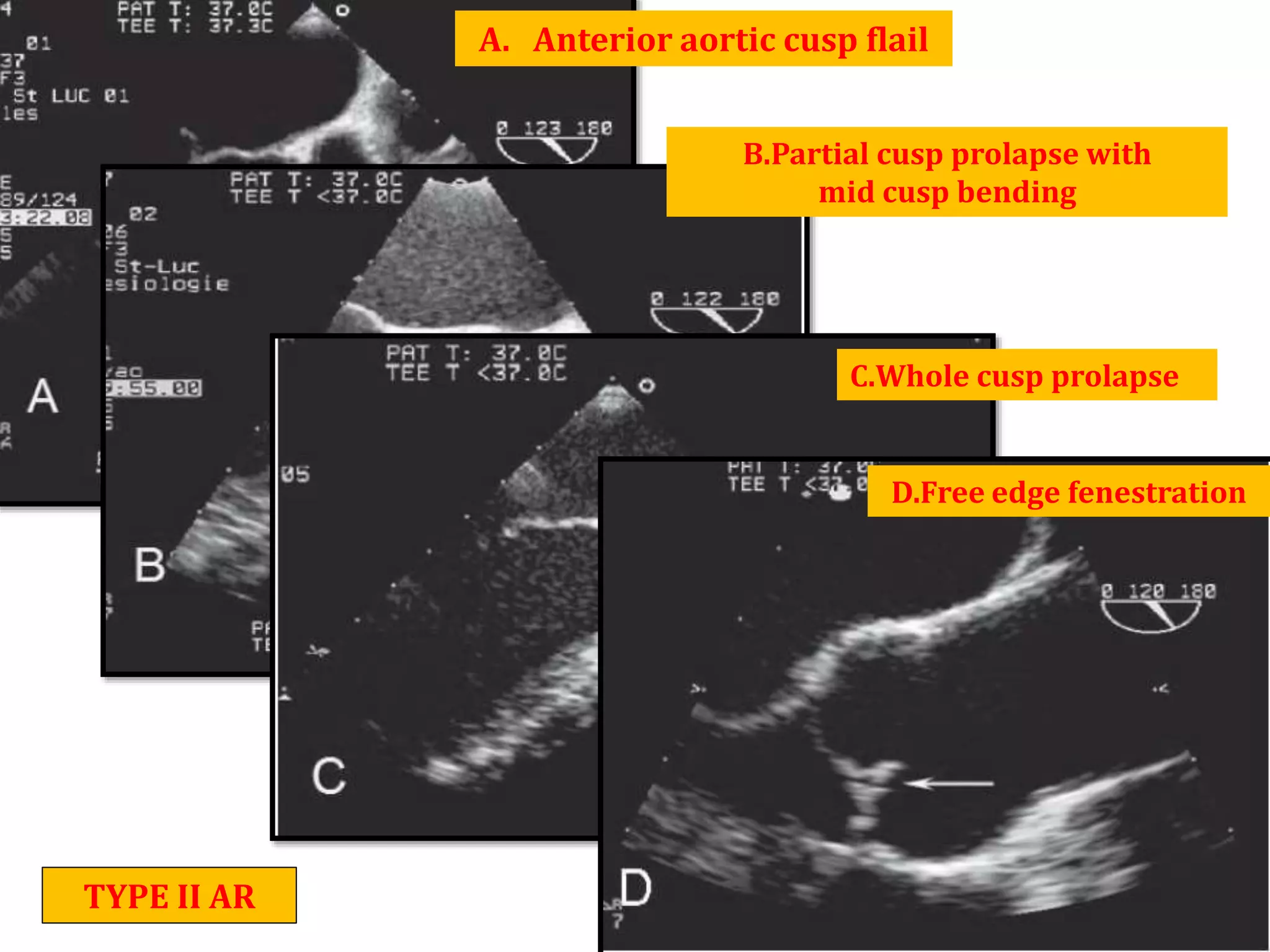 ECHOCARDIOGRAPHIC EVALUATION OF AORTIC REGURGITATION | PPTX