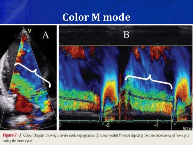 ECHOCARDIOGRAPHIC EVALUATION OF AORTIC REGURGITATION