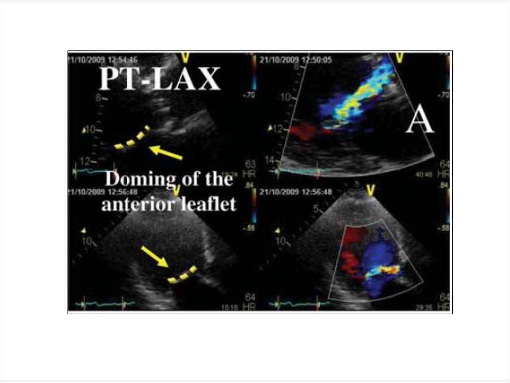 Echocardiography Evaluation Of Aortic Regurgitation Comprehensive