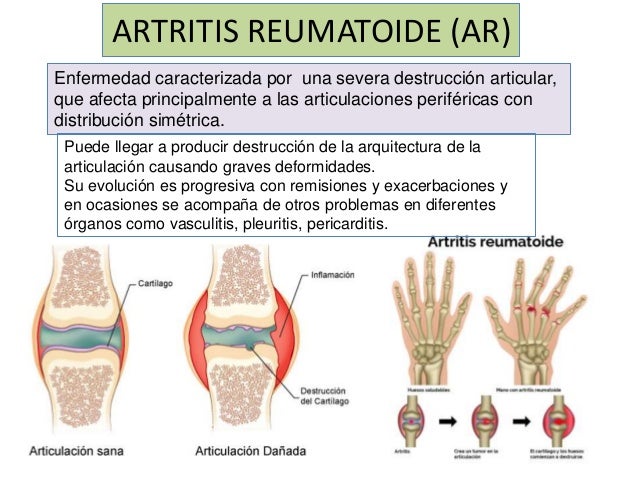 Artritis Reumatoide Ar