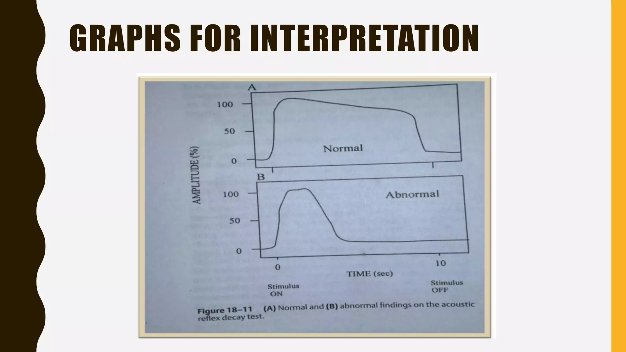 Acoustic Reflex (AR) and Tone decay (TDT) | PPTX