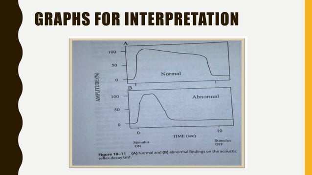 Acoustic Reflex (AR) and Tone decay (TDT) | PPTX