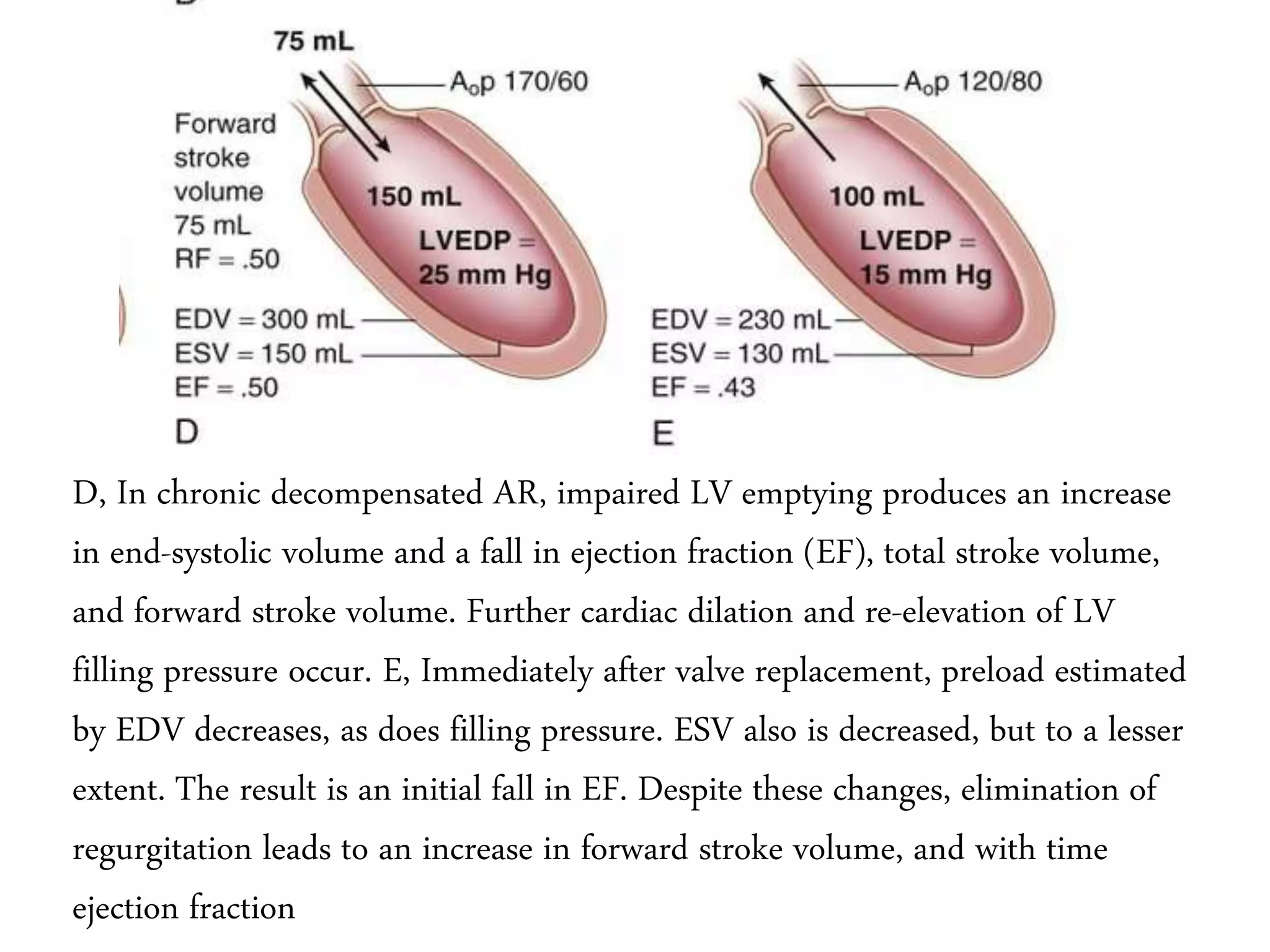 Pathophysiology of aortic regurgitation and management | PPTX