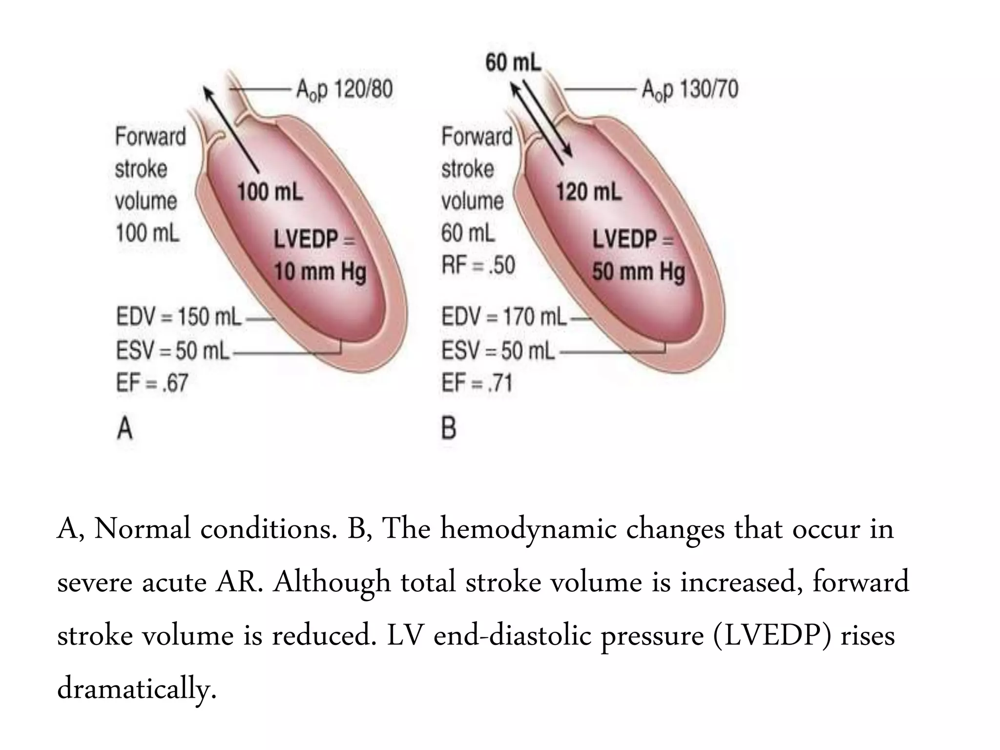 Pathophysiology of aortic regurgitation and management | PPTX
