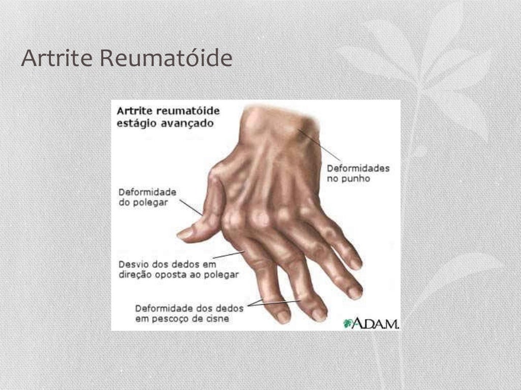 ARTRITE REUMATÓIDE