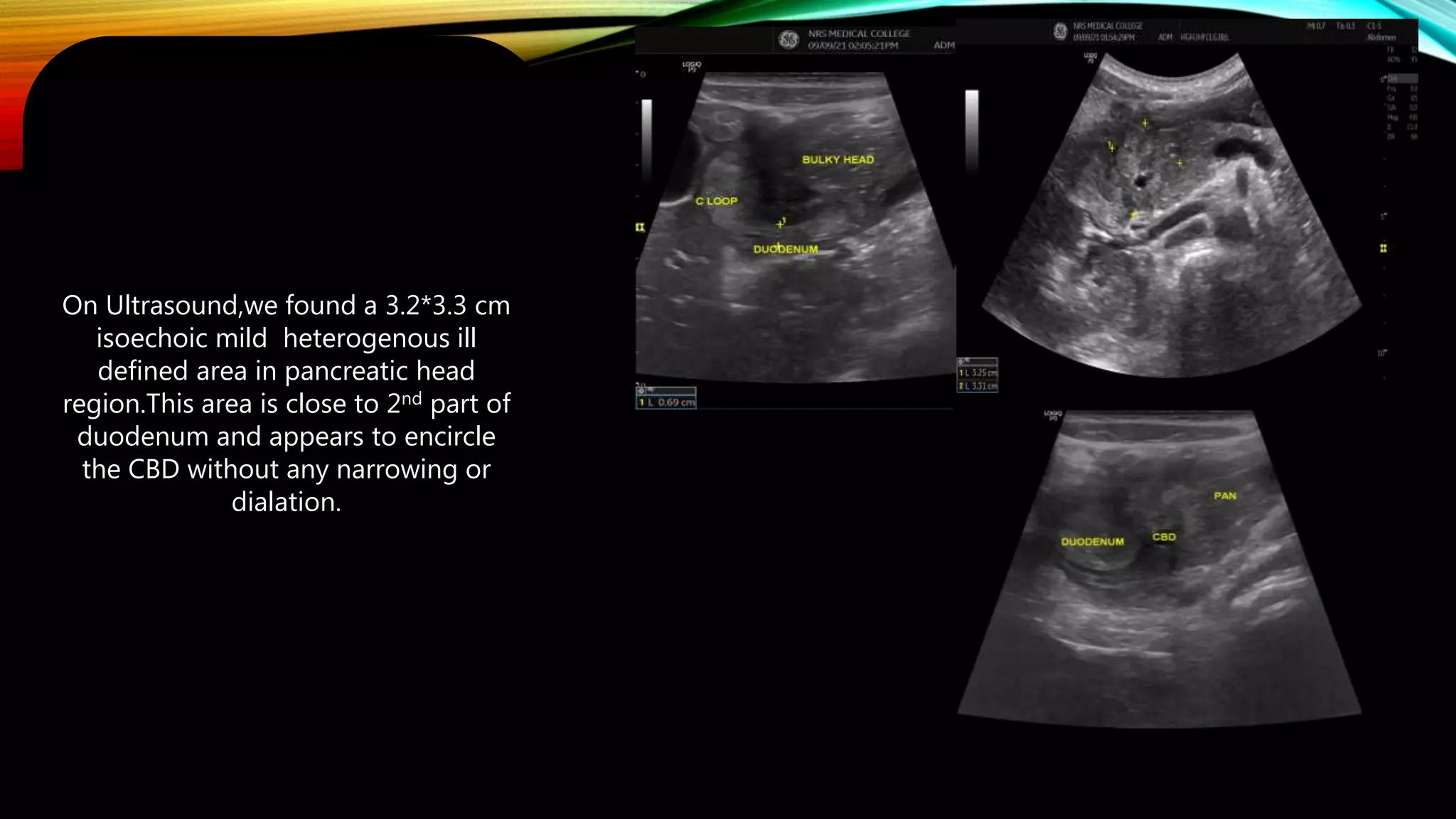 A rare case of groove pancreatitis from radiologic perspective | PPTX