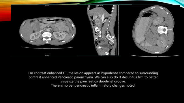 A rare case of groove pancreatitis from radiologic perspective | PPTX
