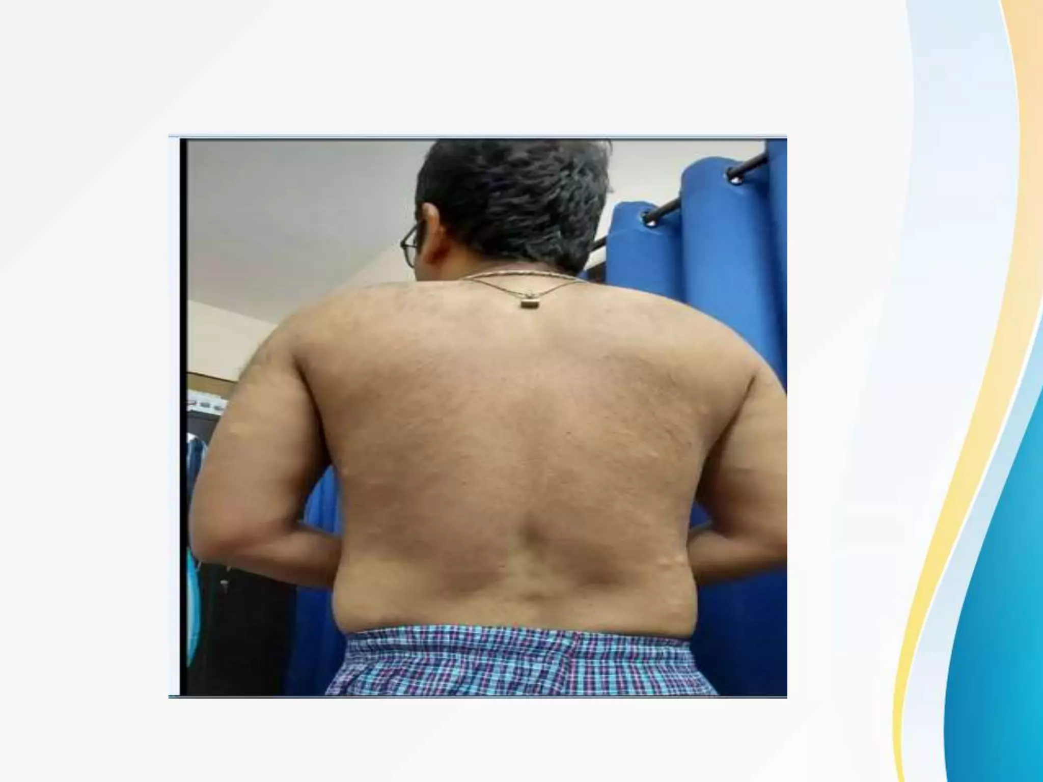 A RARE CASE OF THE GREAT IMITATOR IN DERMATOLOGY-SARCOIDOSIS.pptx