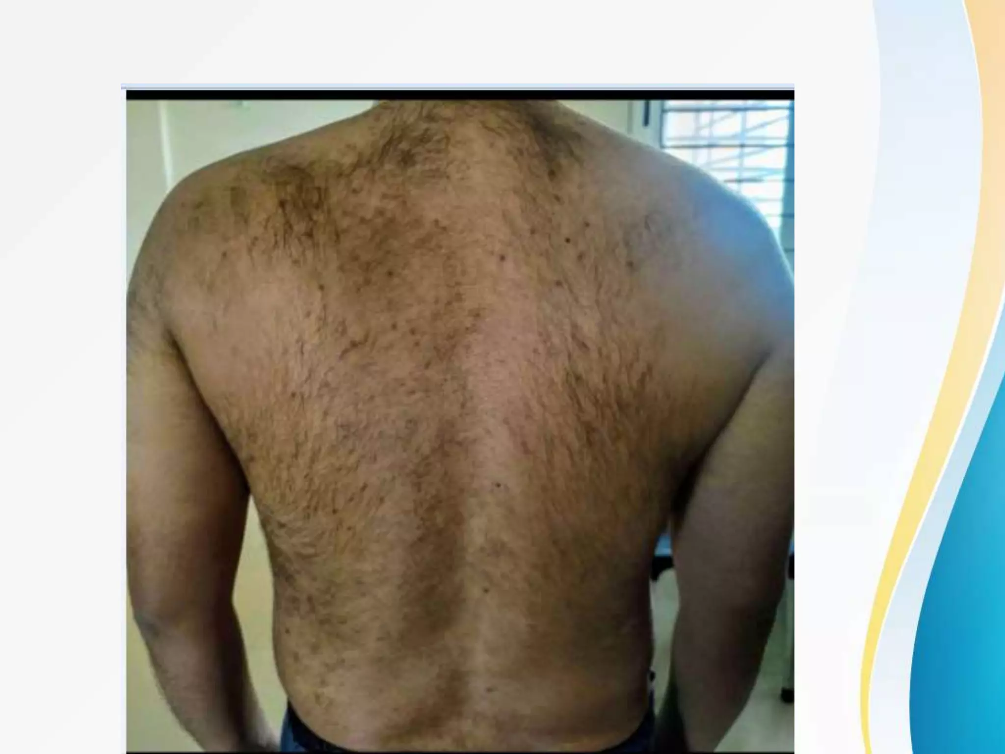 A RARE CASE OF THE GREAT IMITATOR IN DERMATOLOGY-SARCOIDOSIS.pptx