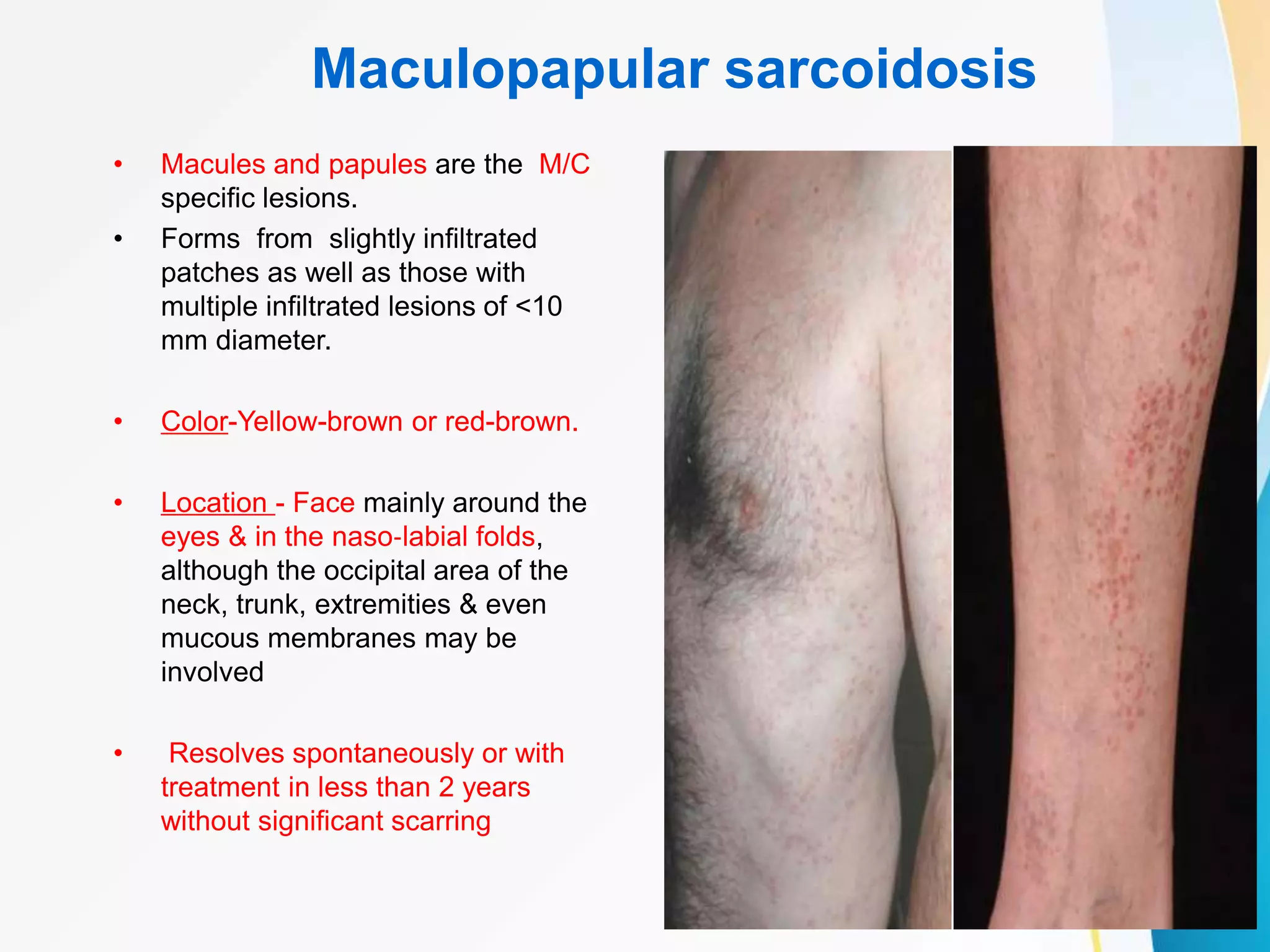 A RARE CASE OF THE GREAT IMITATOR IN DERMATOLOGY-SARCOIDOSIS.pptx