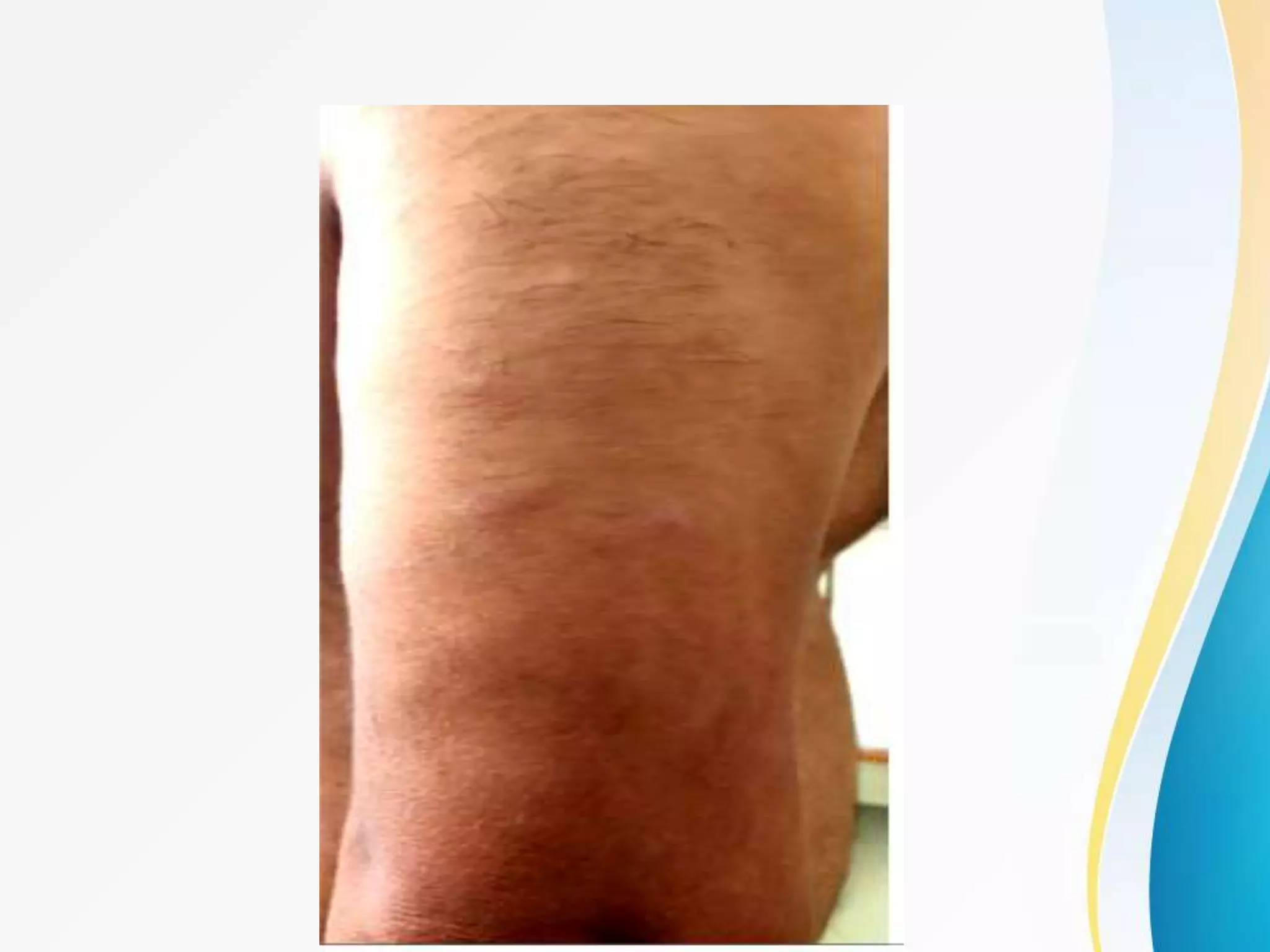 A RARE CASE OF THE GREAT IMITATOR IN DERMATOLOGY-SARCOIDOSIS.pptx