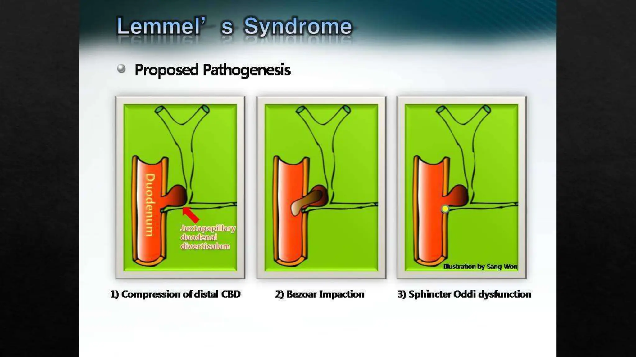 A rare cause of obstructive jaundice -Lemmels [Autosaved].pptx