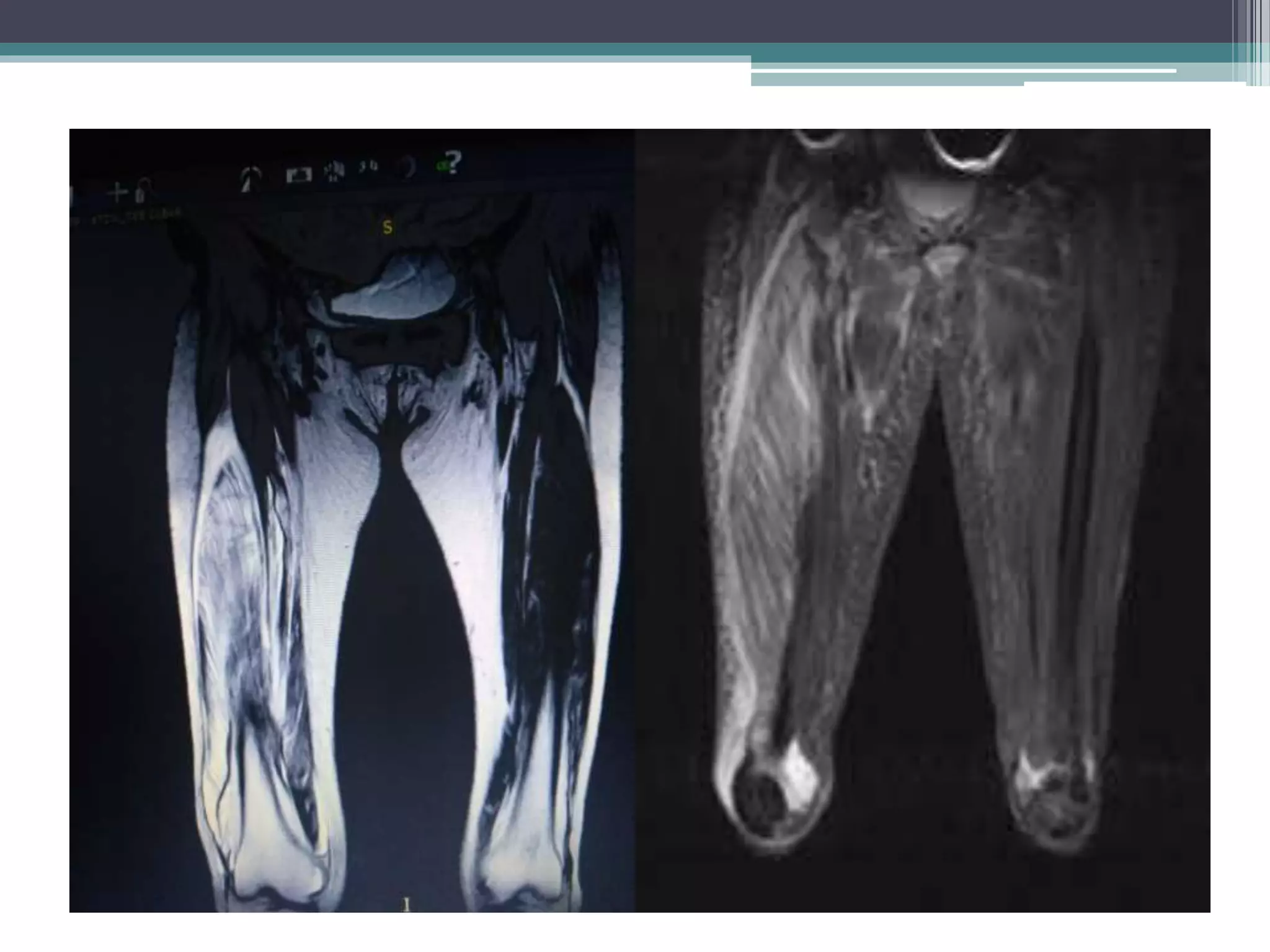 A rare entity of diabetic myonecrosis | PPTX