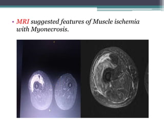 A rare entity of diabetic myonecrosis | PPTX