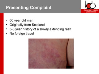 A Rash Decision - A case study on Lyme Disease | PPT