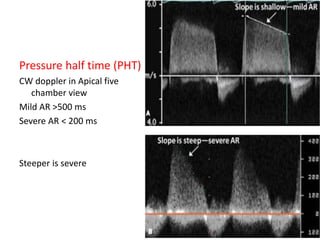 aortic regurgitation assessment by ECHO. | PPTX | Heart and ...