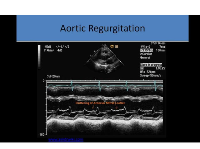 aortic regurgitation assessment by ECHO. | PPTX | Heart and ...