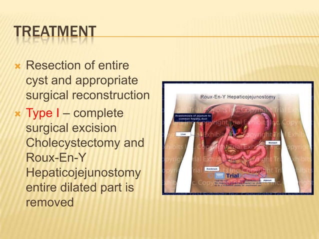 Choledochal cyst | PPTX | Digestive Disorders | Diseases and Conditions