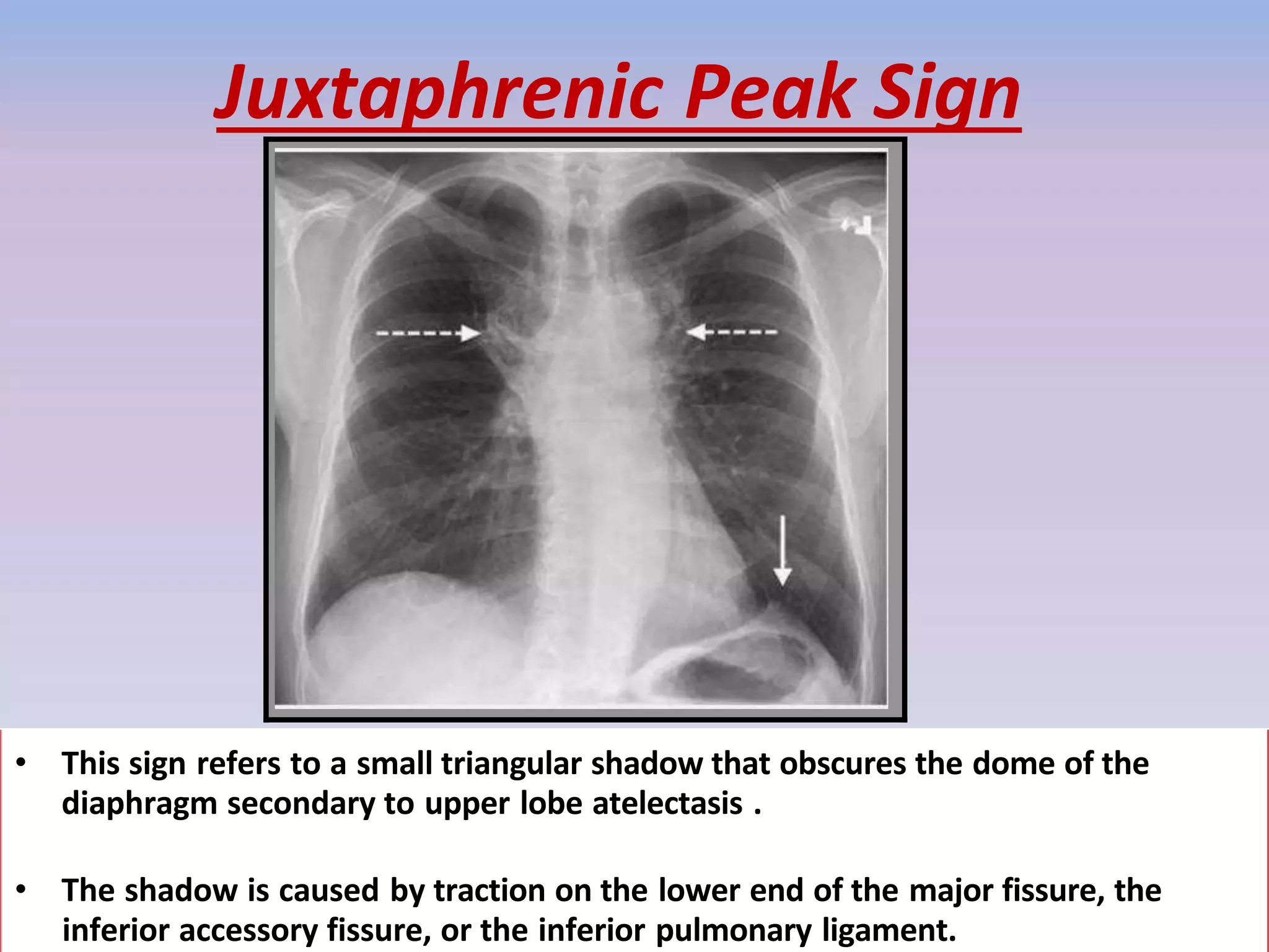 arch-k-signs-in-chest-xray-160210003601.pptx