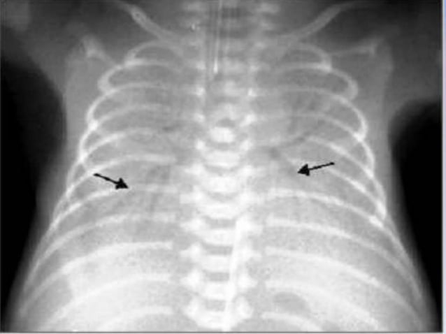 arch-k-signs-in-chest-xray-160210003601.pptx