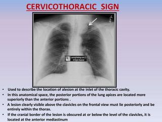 arch-k-signs-in-chest-xray-160210003601.pptx