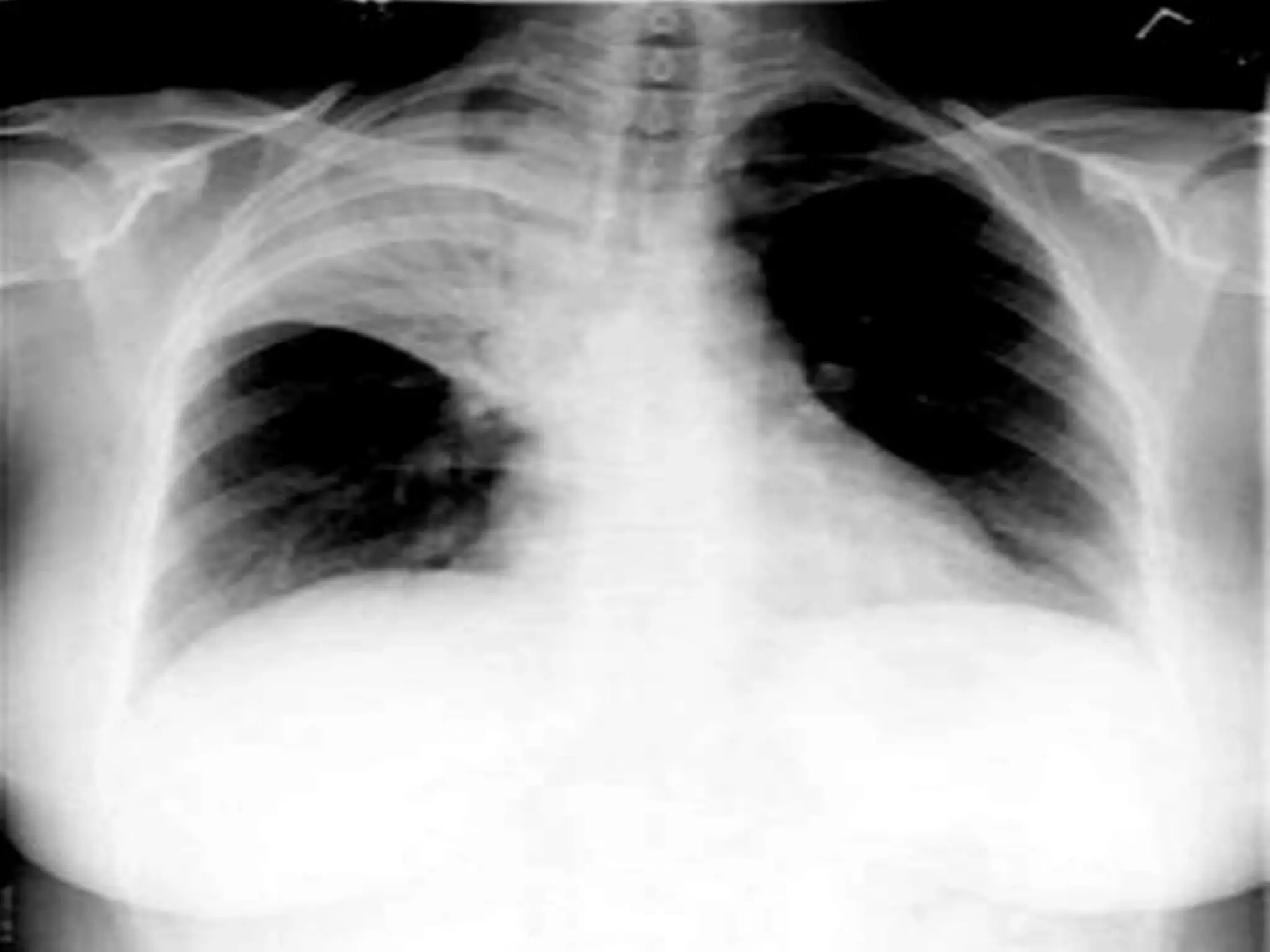 Signs in Chest Xray | PPTX