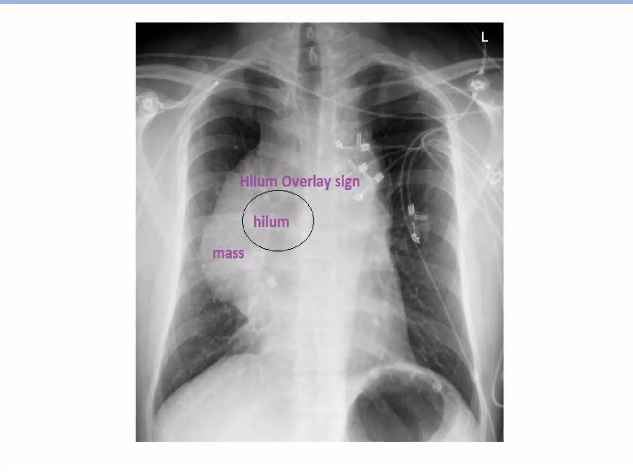 Signs in Chest Xray | PPTX