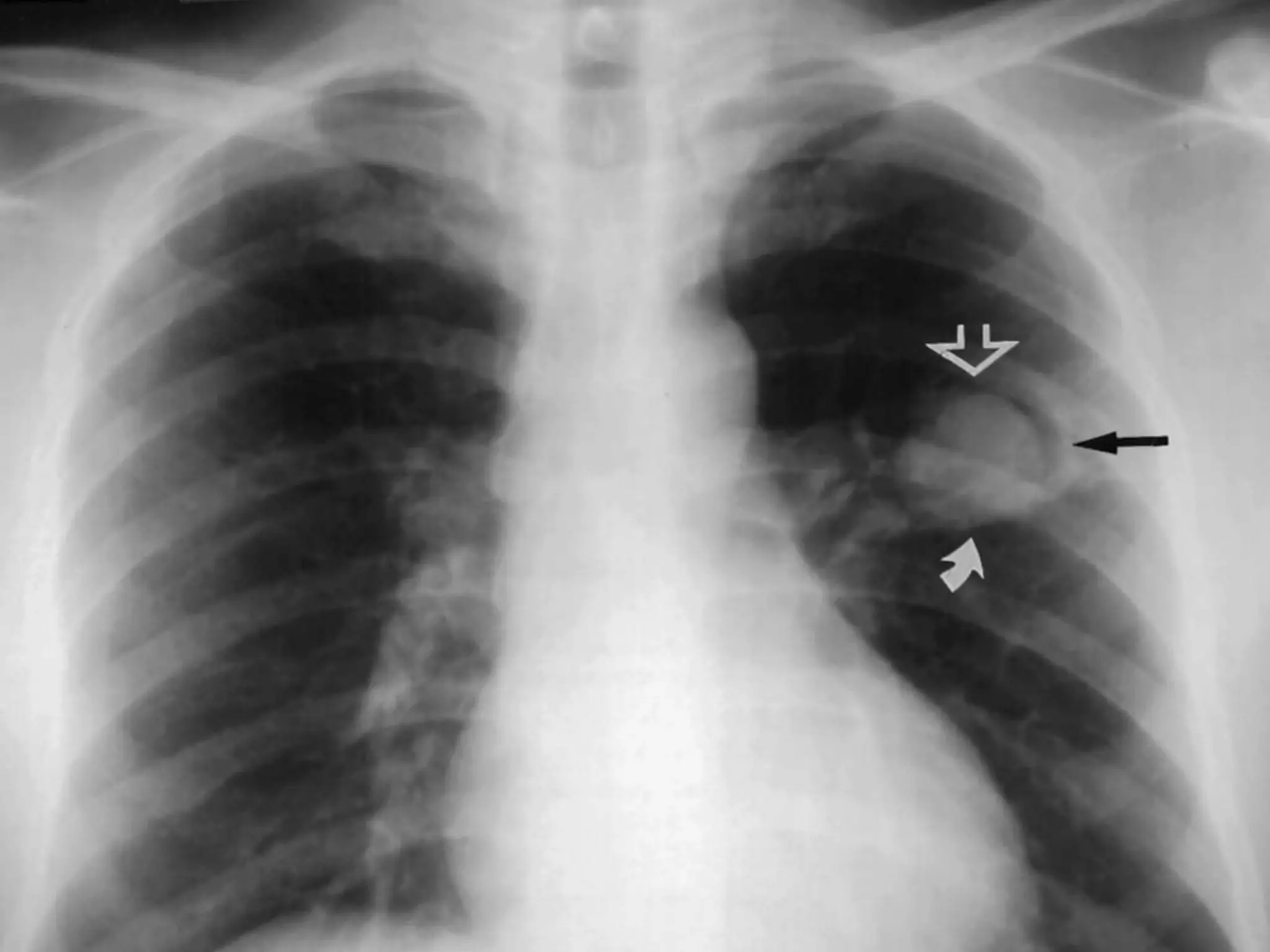Signs in Chest Xray | PPTX