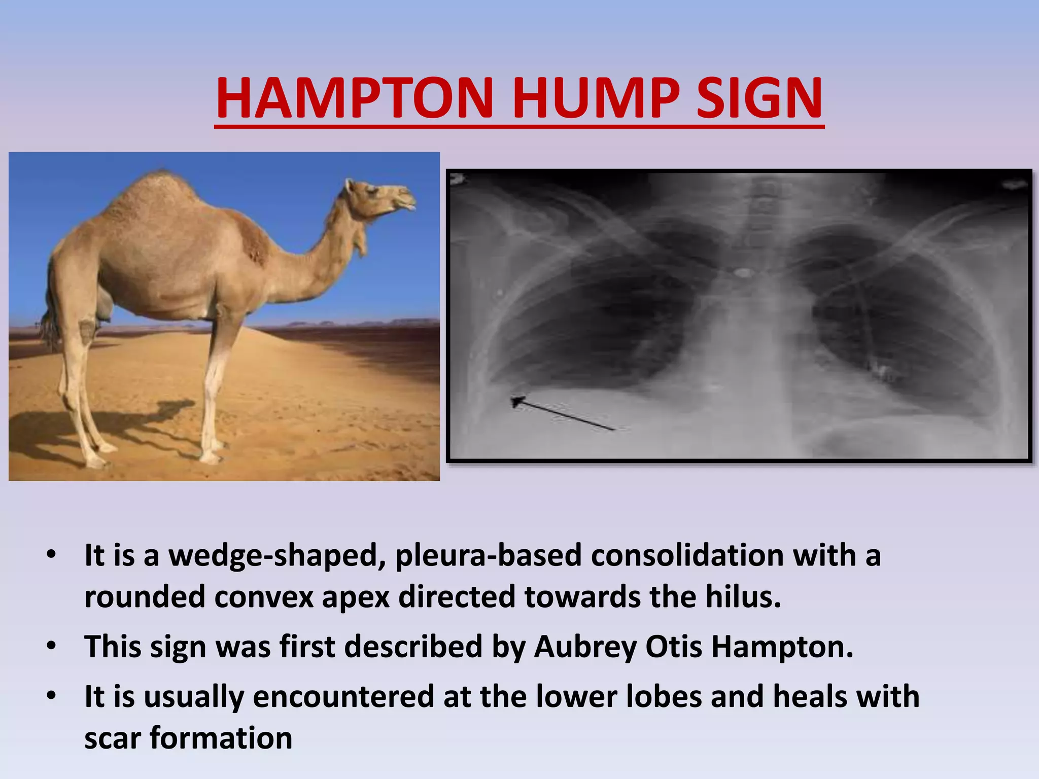 Signs in Chest Xray | PPTX