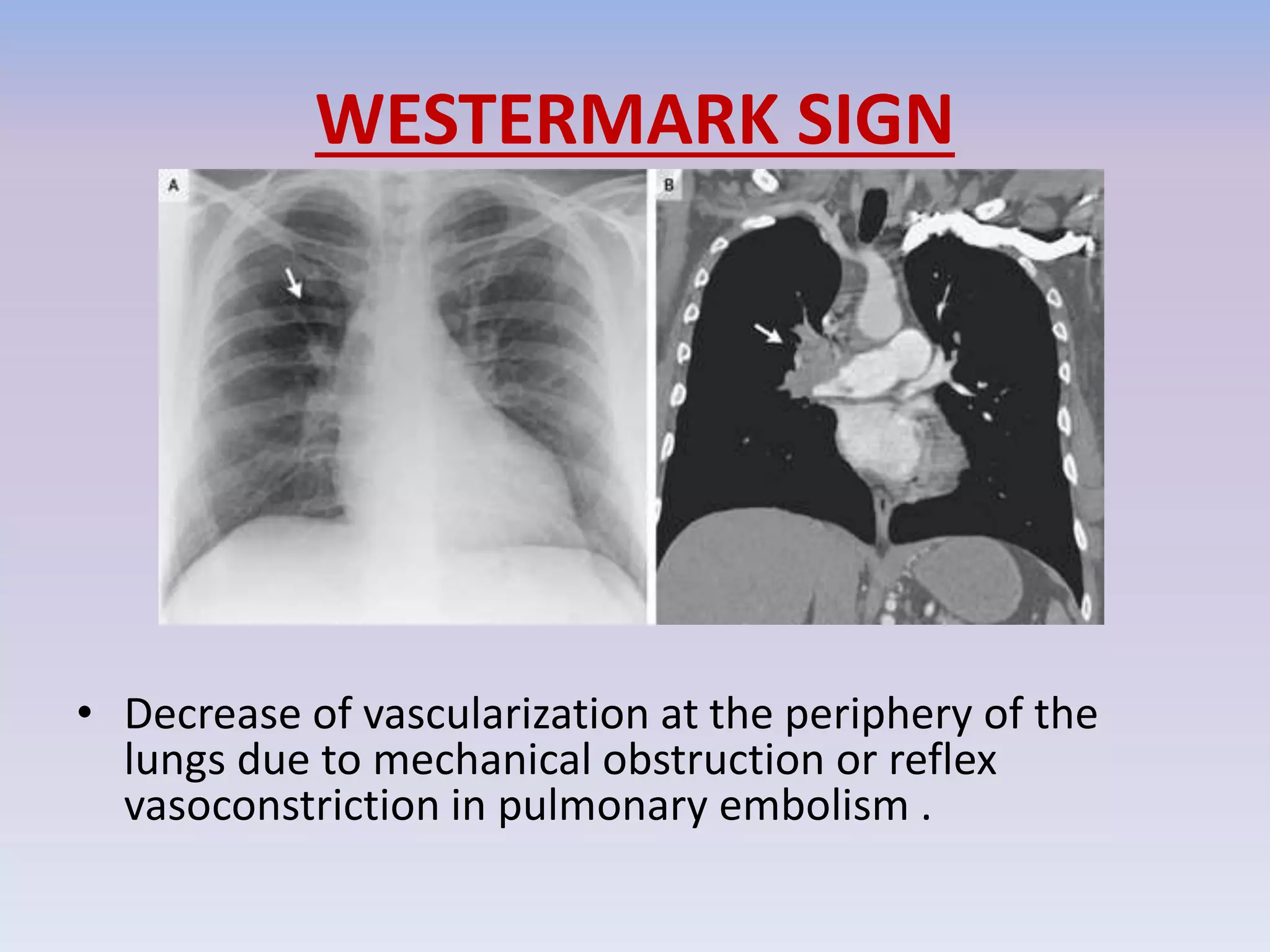 Signs in Chest Xray | PPTX