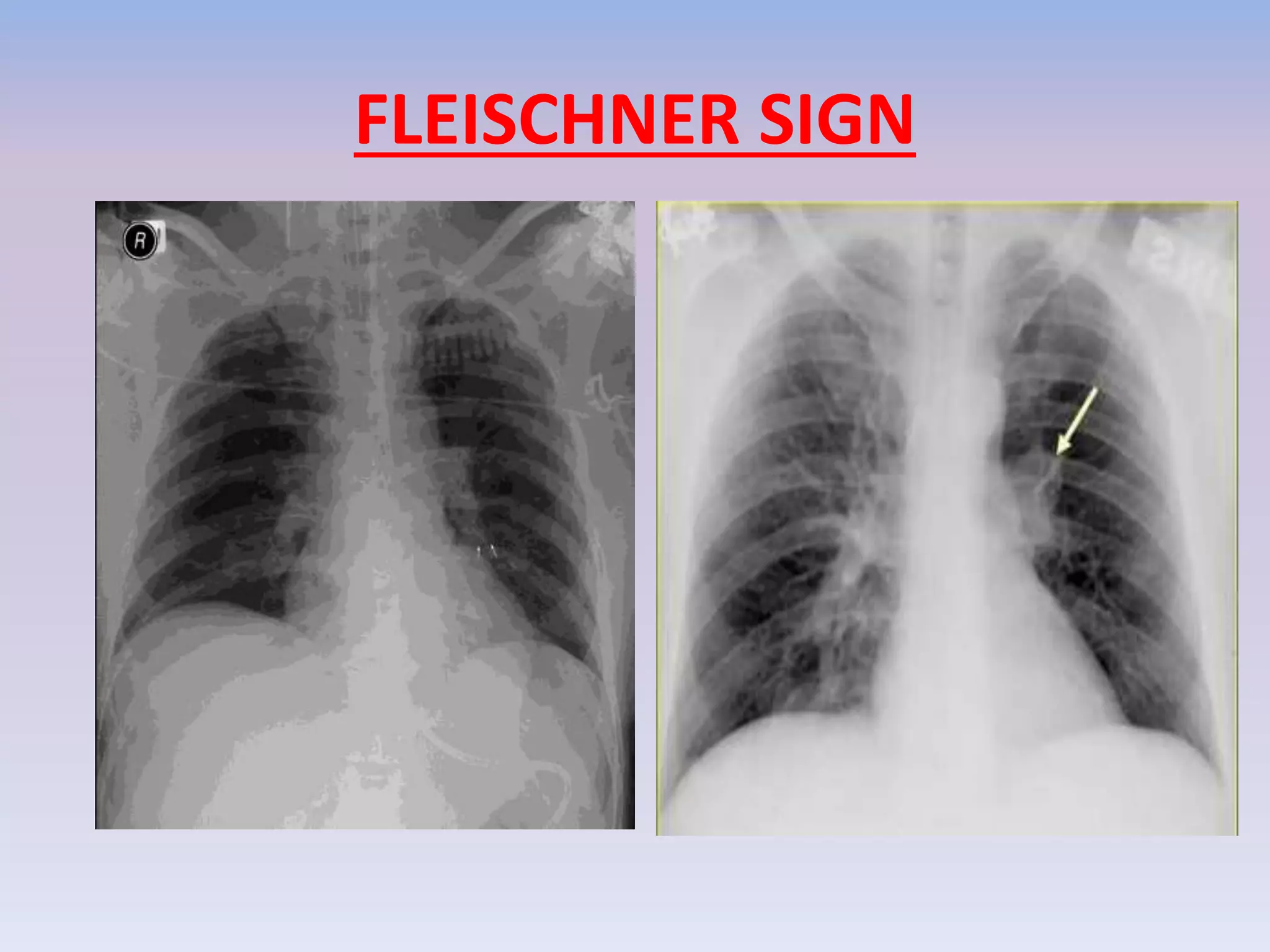 Signs in Chest Xray | PPTX