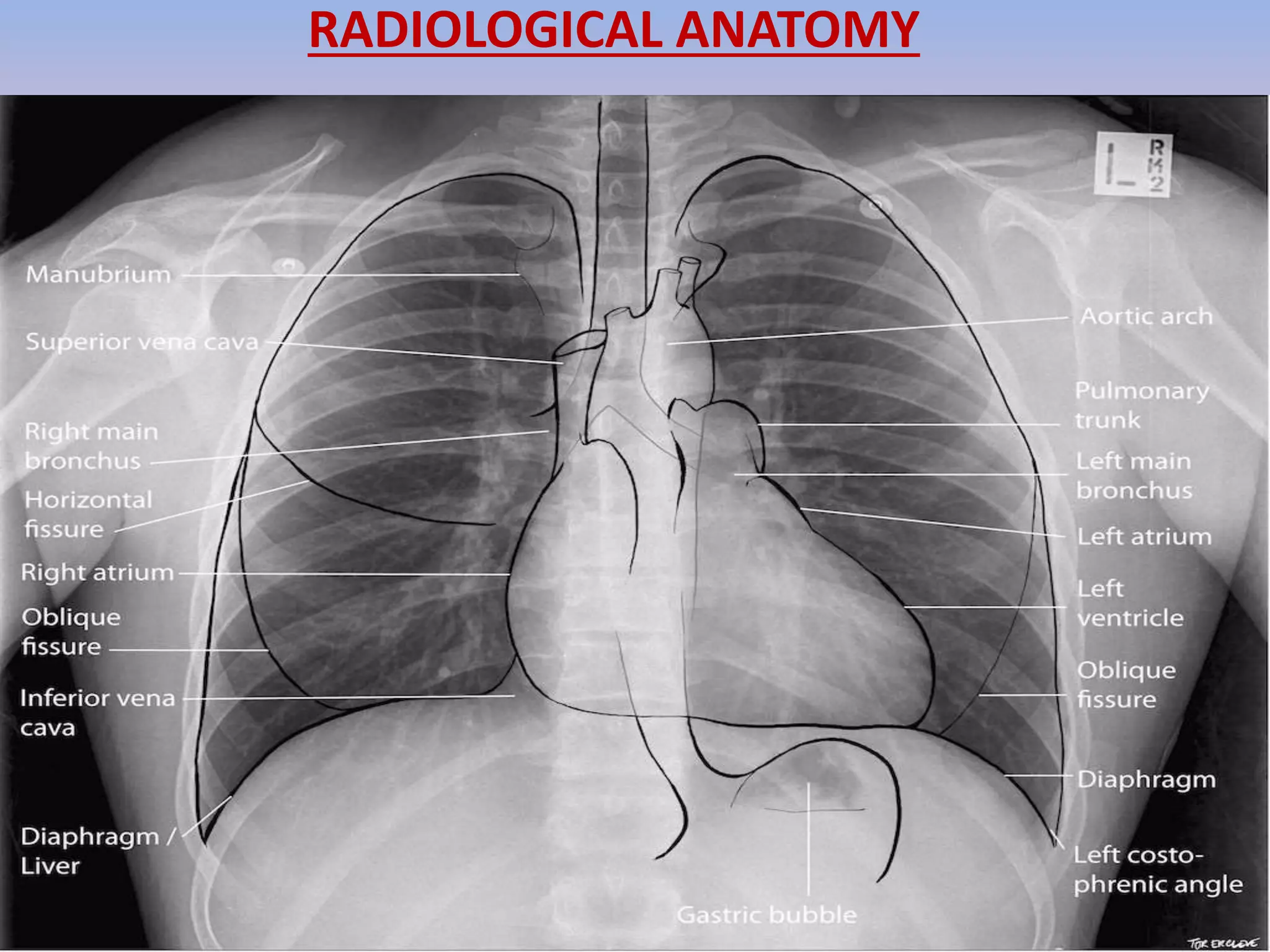 Signs in Chest Xray | PPTX