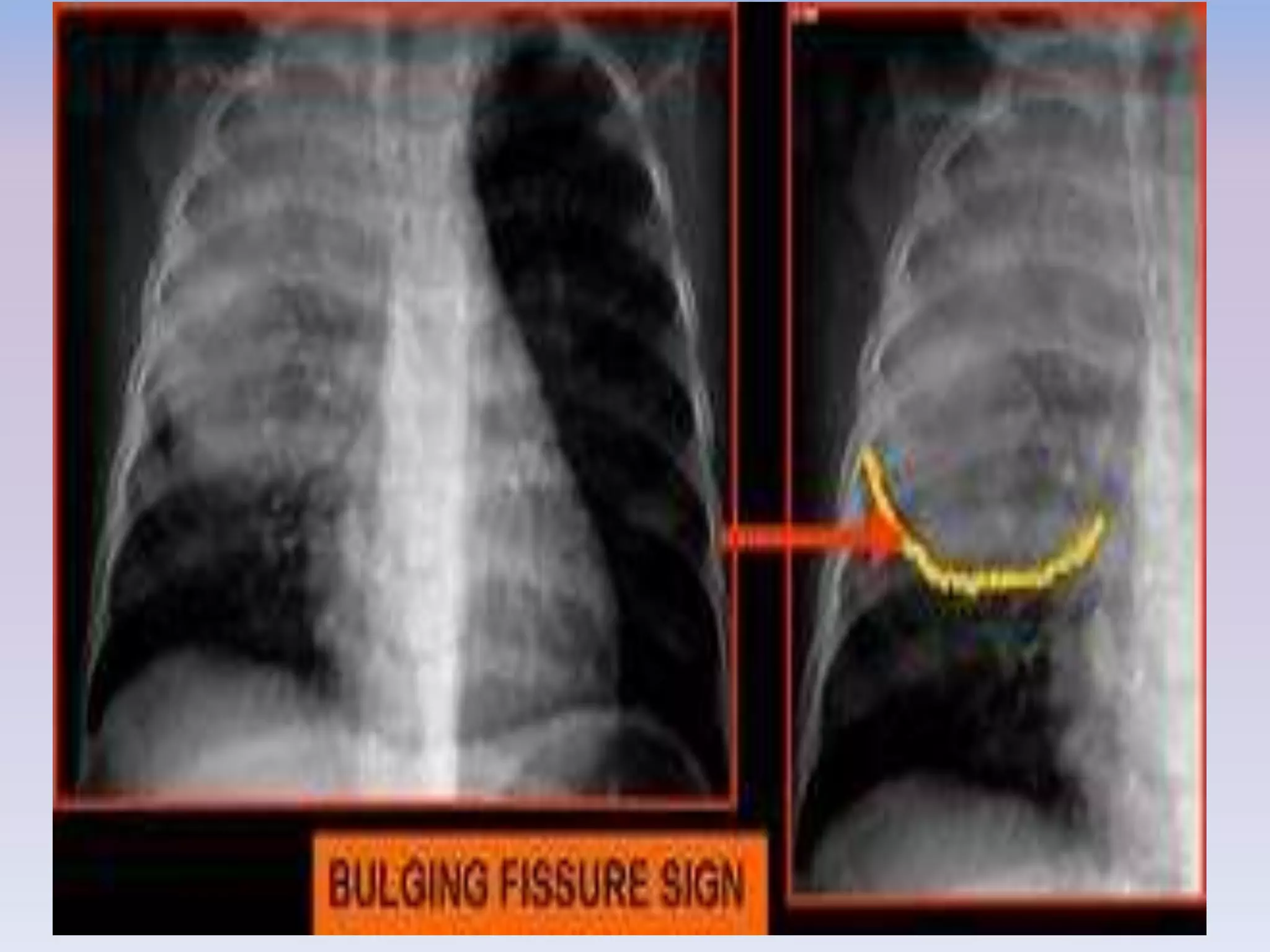 Signs in Chest Xray | PPTX