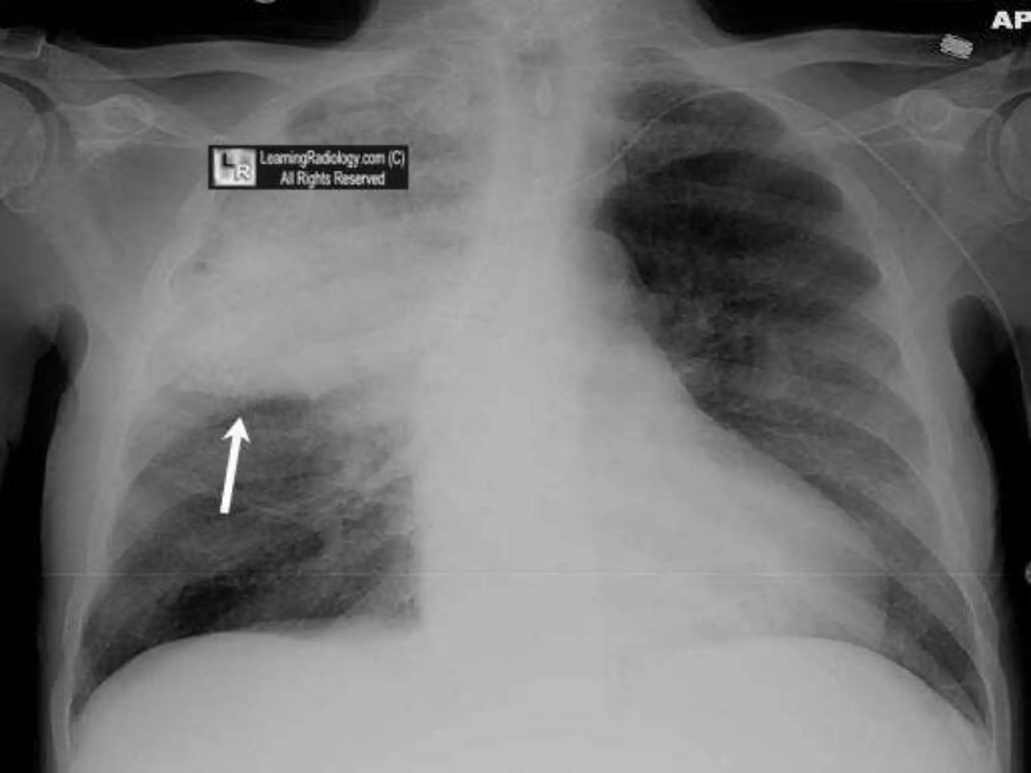Signs in Chest Xray | PPTX