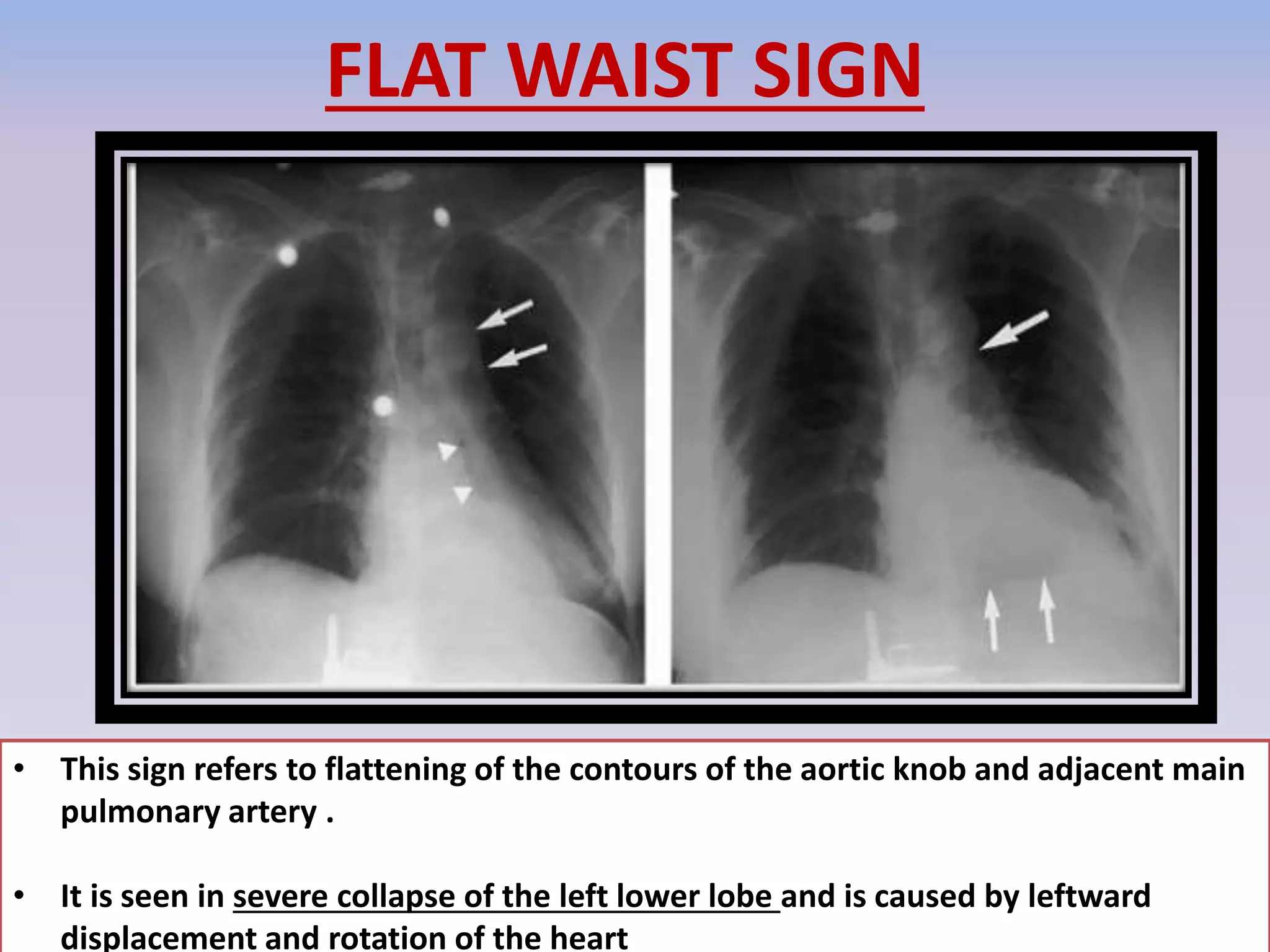 Signs in Chest Xray | PPTX