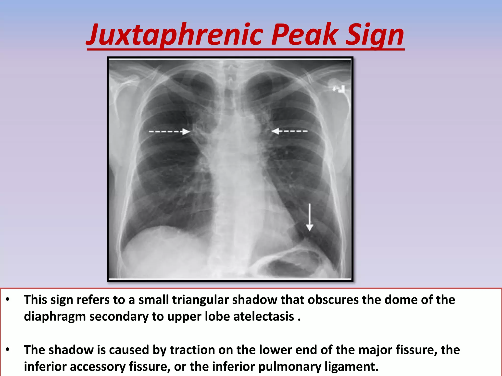 Signs in Chest Xray | PPTX