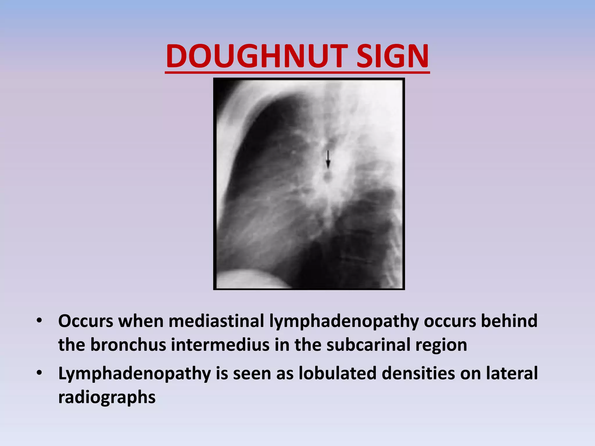 Signs in Chest Xray | PPTX