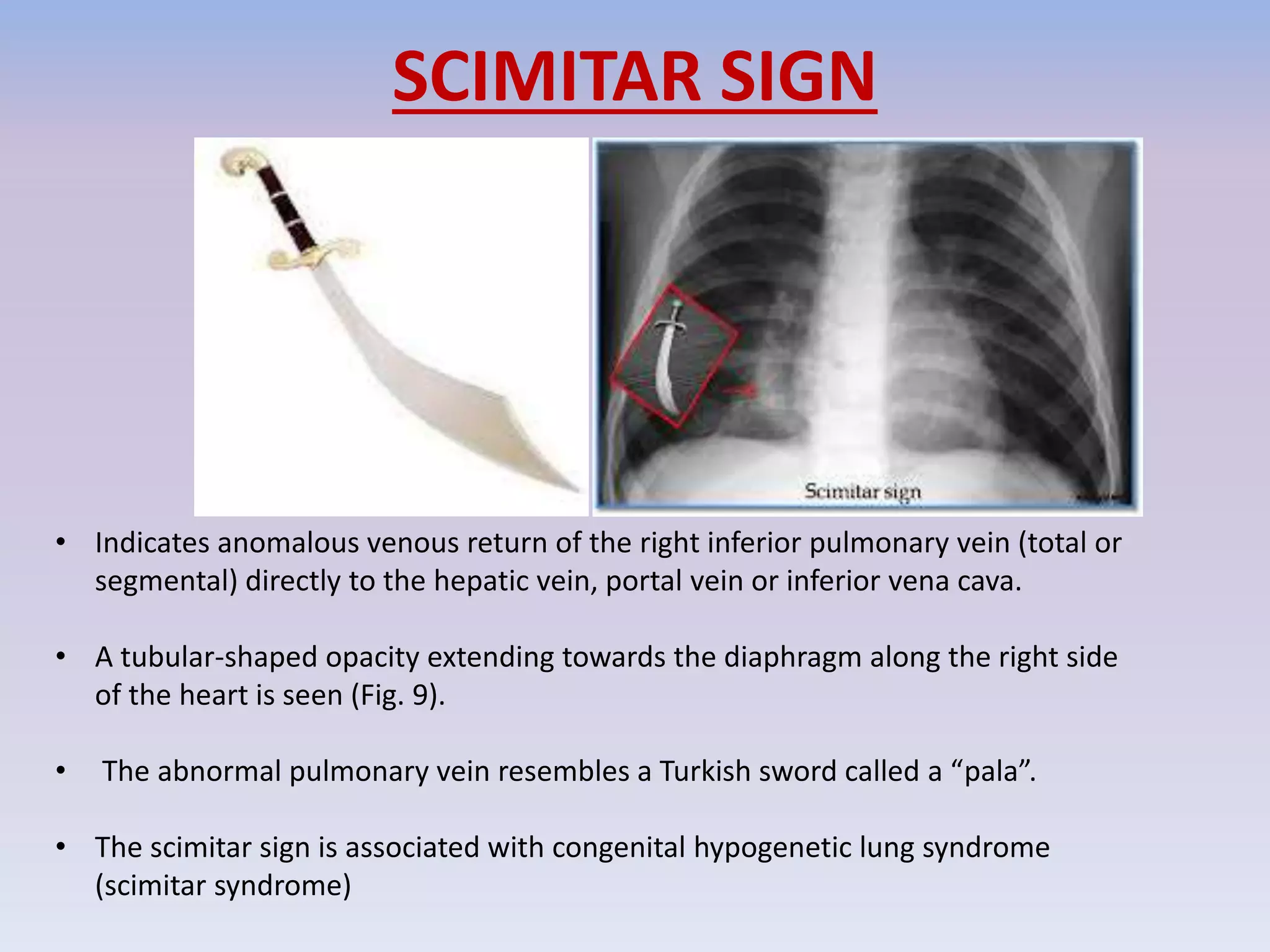 Signs in Chest Xray | PPTX