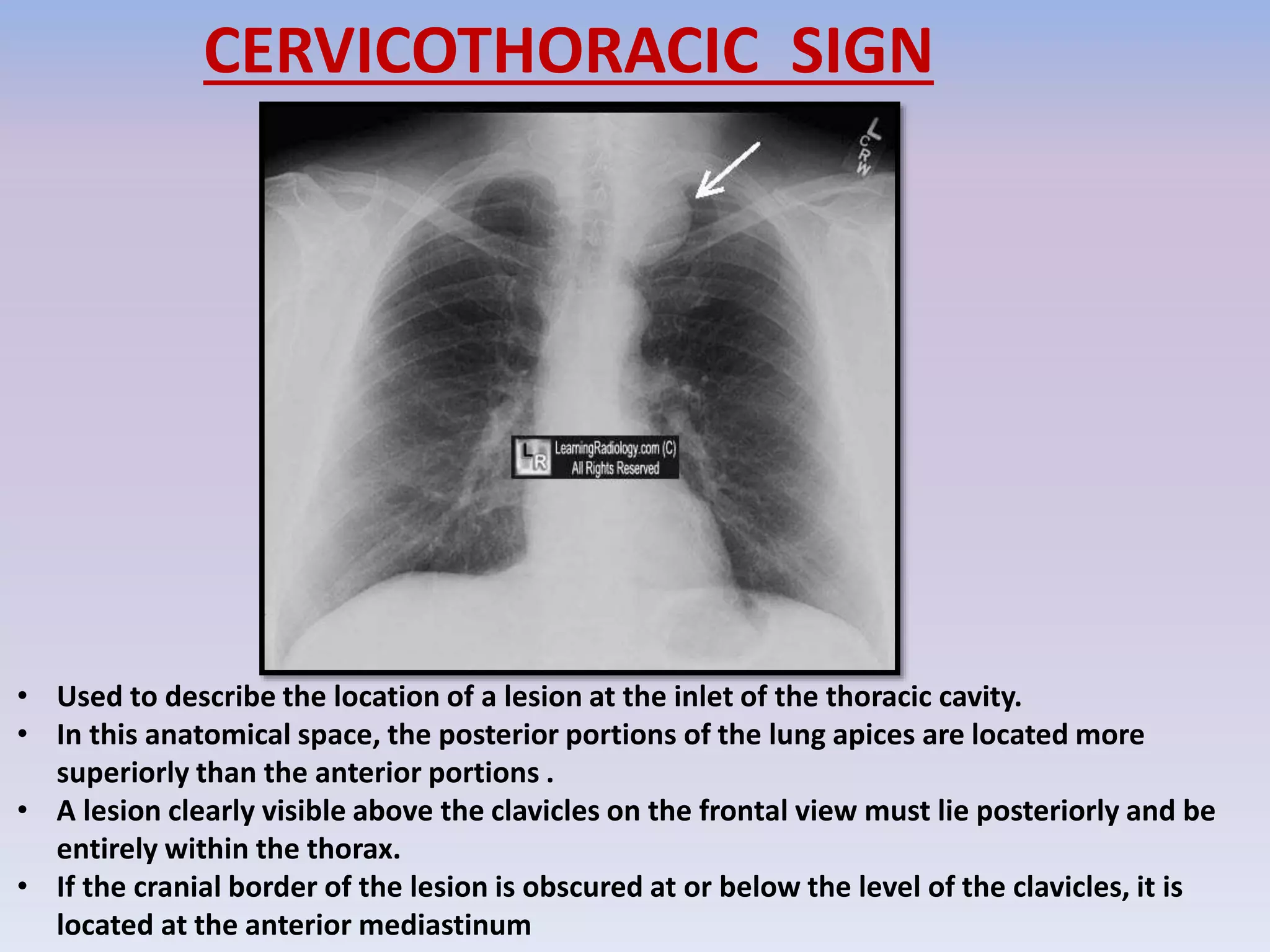 Signs in Chest Xray | PPTX