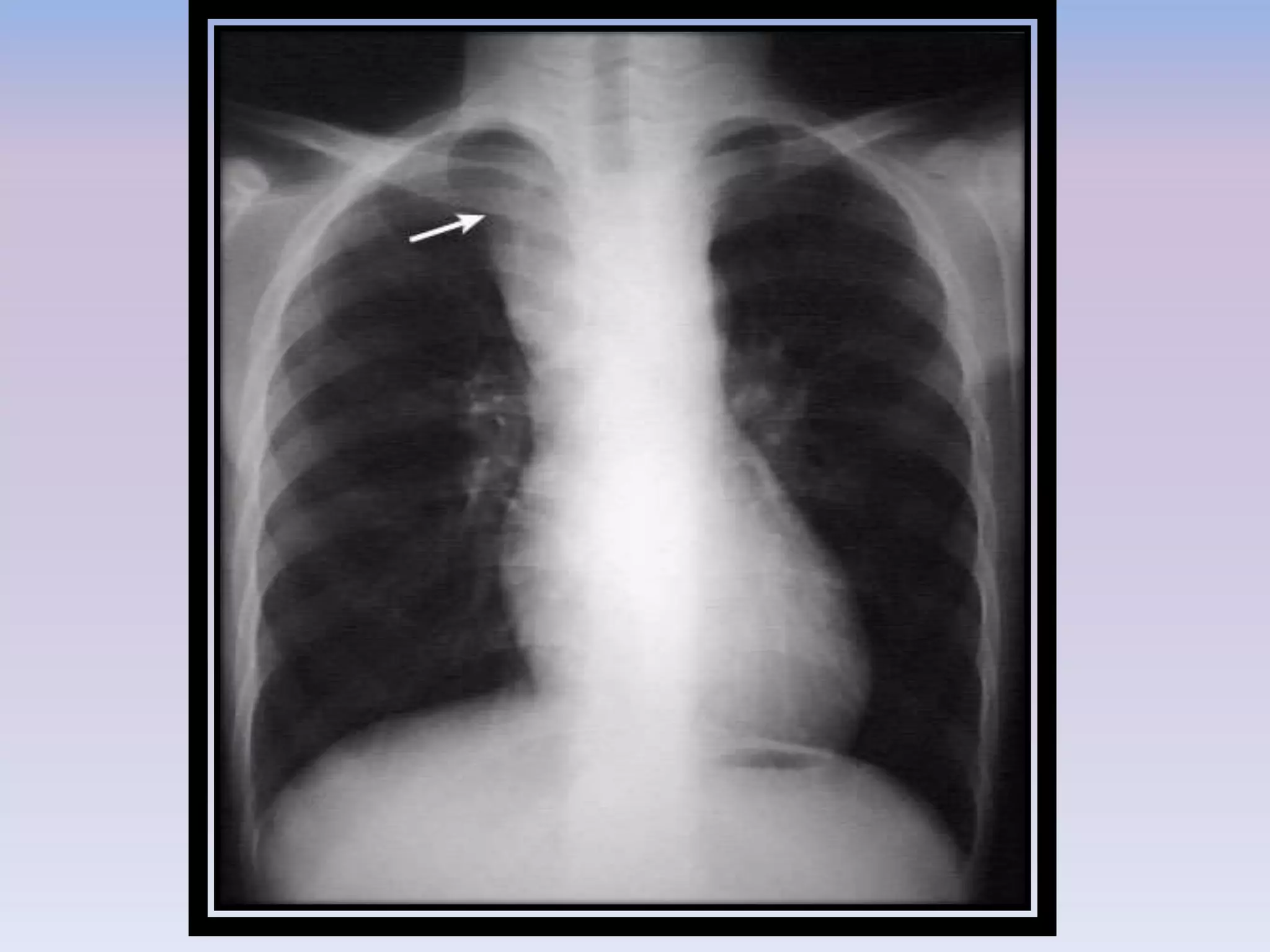 Signs in Chest Xray | PPTX