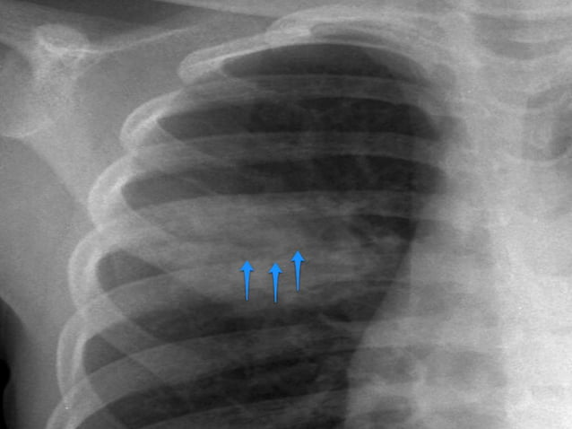 Signs in Chest Xray | PPTX | Lung and Respiratory Health | Diseases and ...