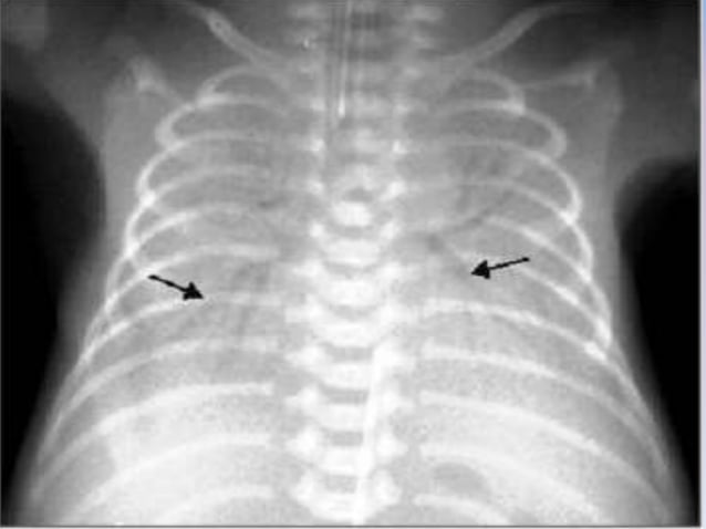 Signs in Chest Xray | PPTX | Lung and Respiratory Health | Diseases and ...