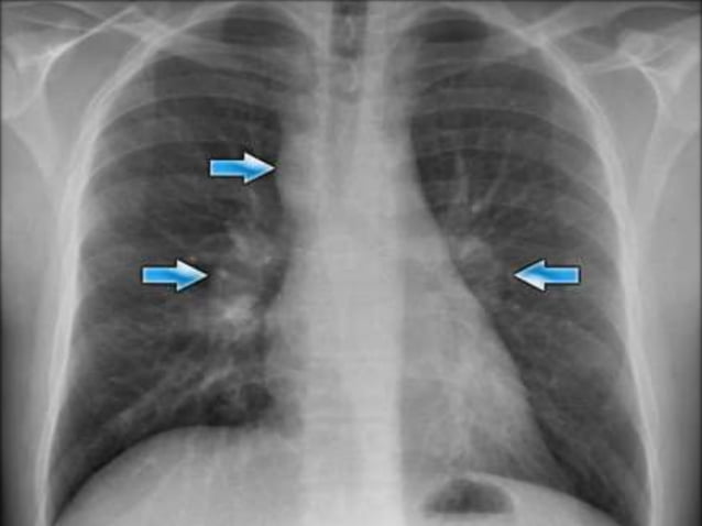 Signs in Chest Xray | PPTX | Lung and Respiratory Health | Diseases and ...