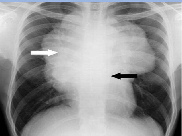 Signs in Chest Xray | PPTX | Lung and Respiratory Health | Diseases and ...