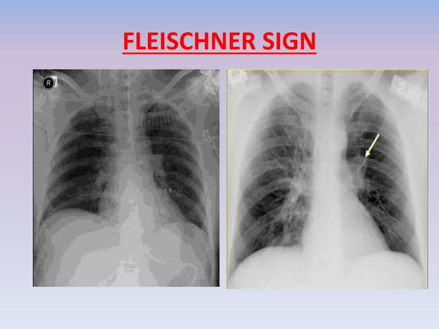 Signs in Chest Xray | PPTX | Lung and Respiratory Health | Diseases and ...