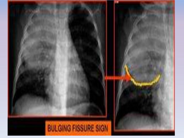 Signs in Chest Xray | PPTX | Lung and Respiratory Health | Diseases and ...