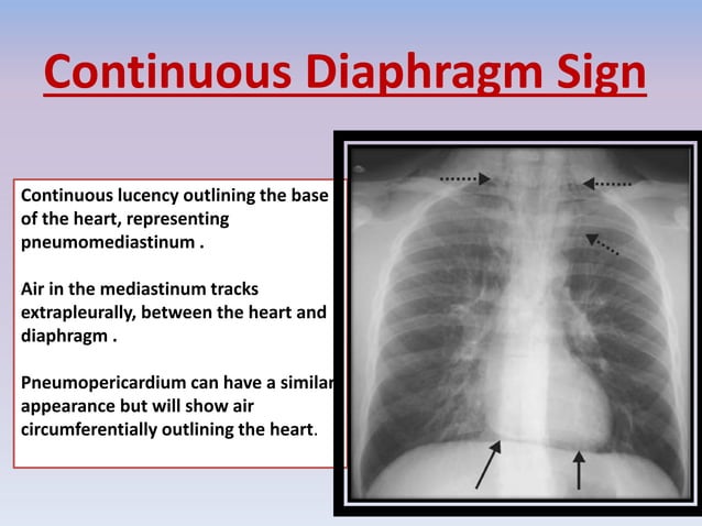 Signs in Chest Xray | PPTX | Lung and Respiratory Health | Diseases and ...