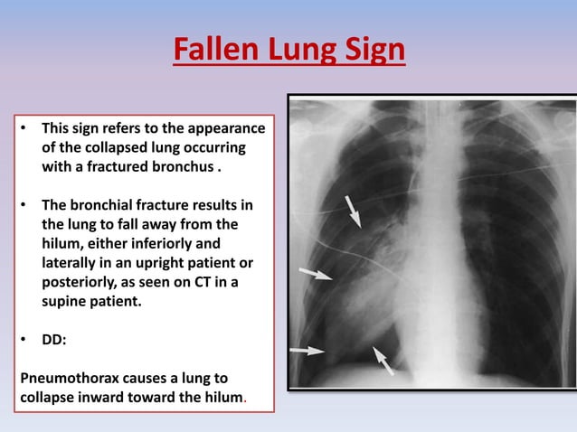 Signs in Chest Xray | PPTX | Lung and Respiratory Health | Diseases and ...